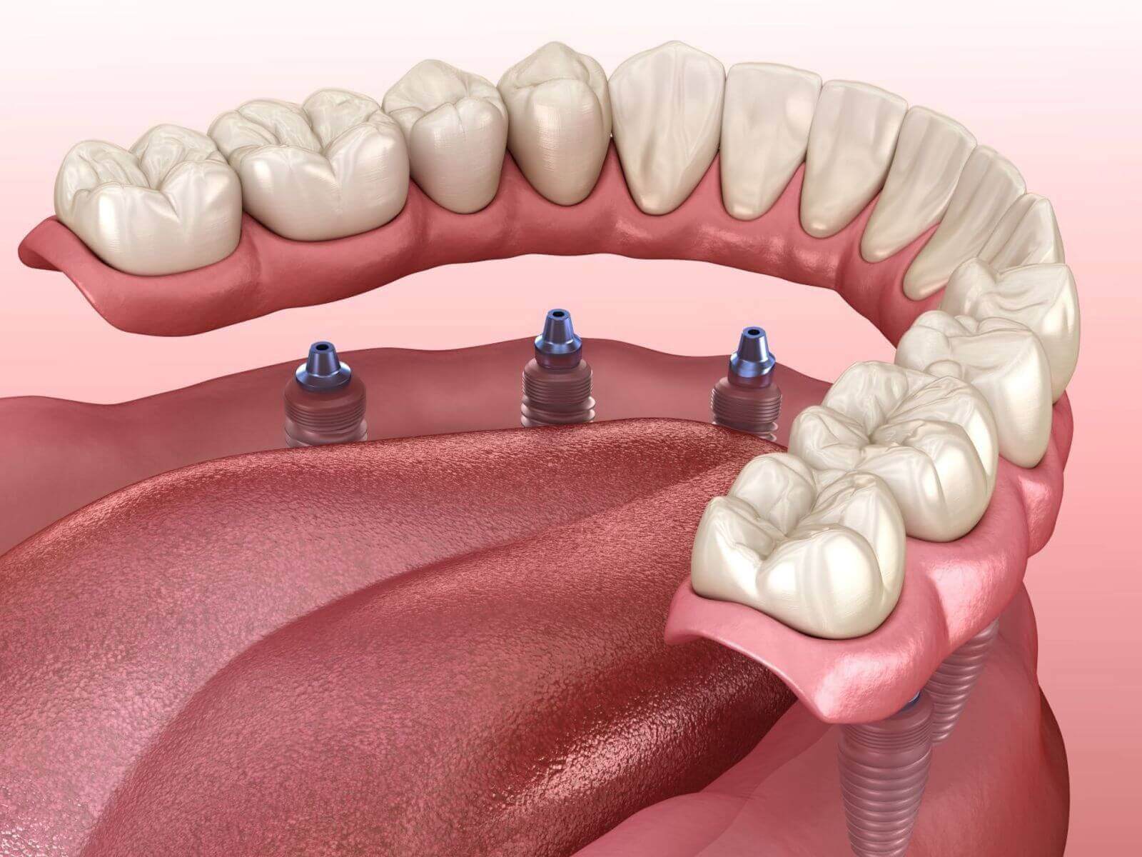 Zahnimplantate Berlin Spandau - Experten bei Smile Health